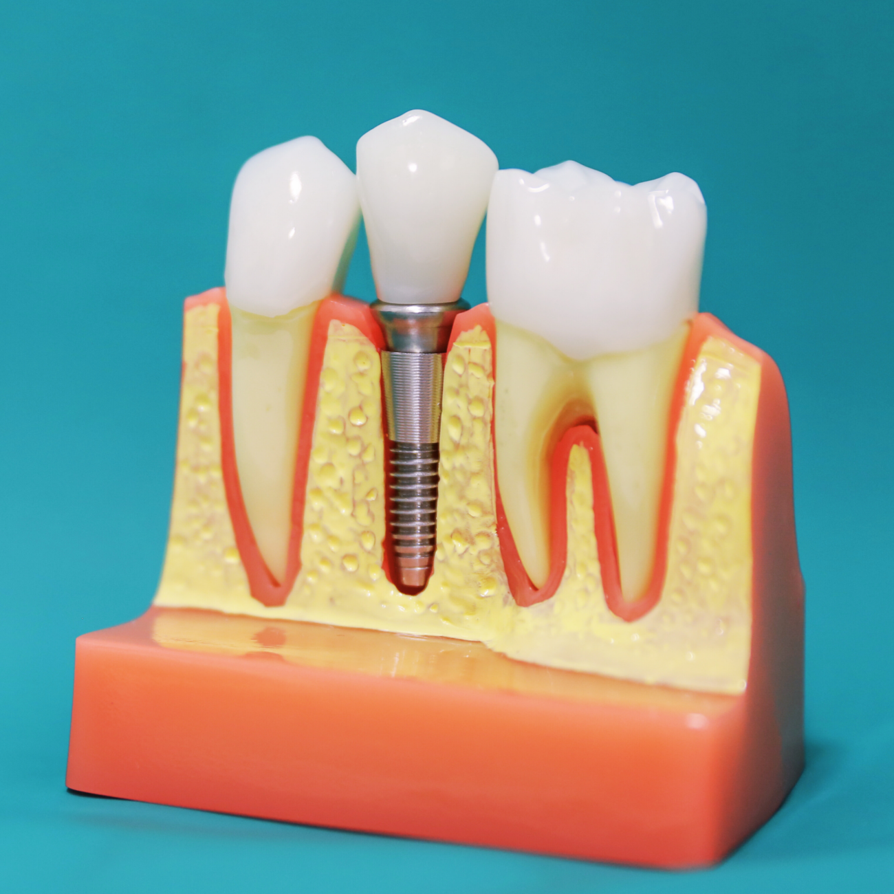 Replace Missing Teeth - Dental Implants - Plano, TX